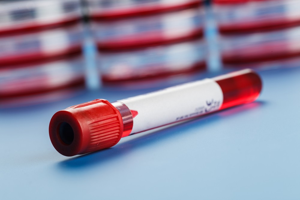 Huntington’s disease blood biomarker identified - Bioanalysis Zone