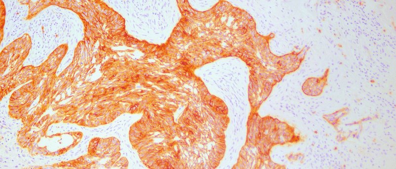 Immunohistochemistry-labeled biomarker panel could aid prostate cancer ...