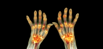 Uncovering the unique and complex autoantibody patterns in rheumatoid arthritis - Bioanalysis Zone