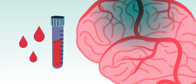 A new blood biomarker for tracking brain injury after stroke - Bioanalysis Zone